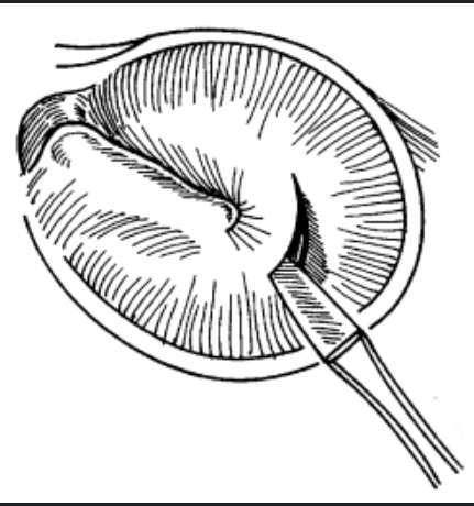 Myringotomy: A Simple Surgery to Treat Chronic Ear Infections and ...