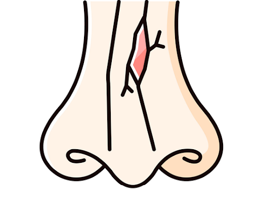 Broken Nose: Symptoms, Treatment, and When to Seek Surgery - Royal ...