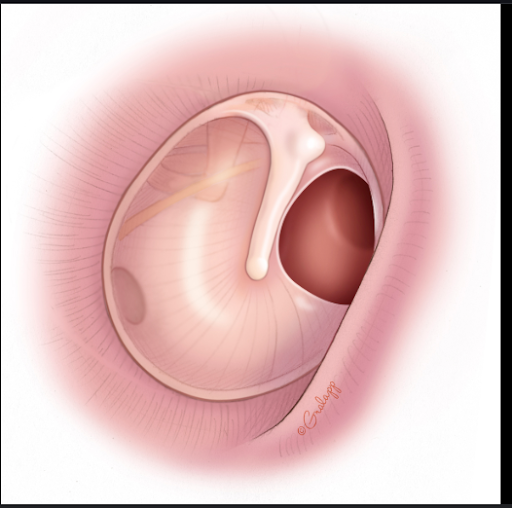 Ruptured Eardrum: Causes, Symptoms, Treatment & Recovery Tips - Royal Pearl hospital